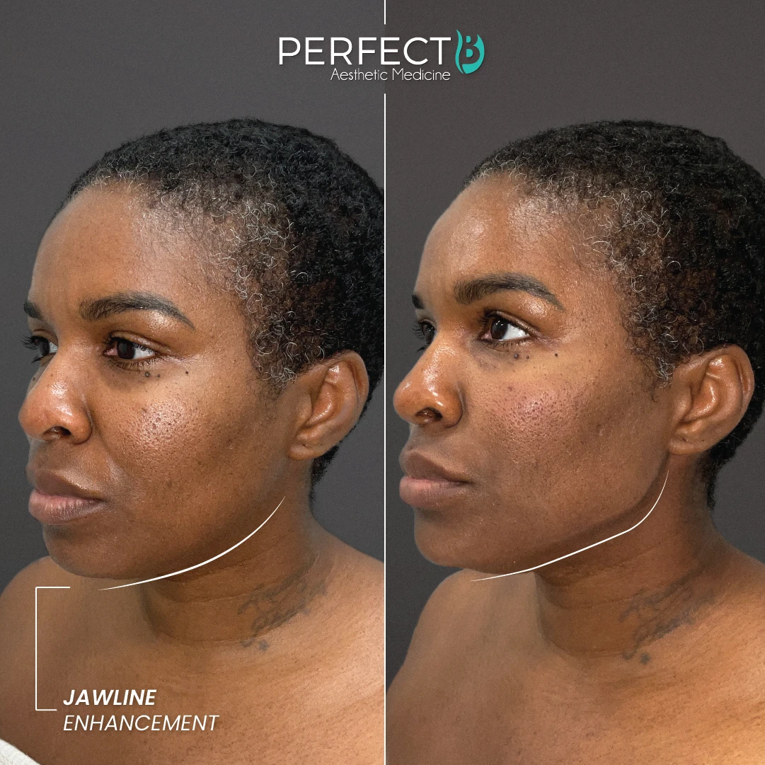 Jawline Enhancement Treatment | Perfect B