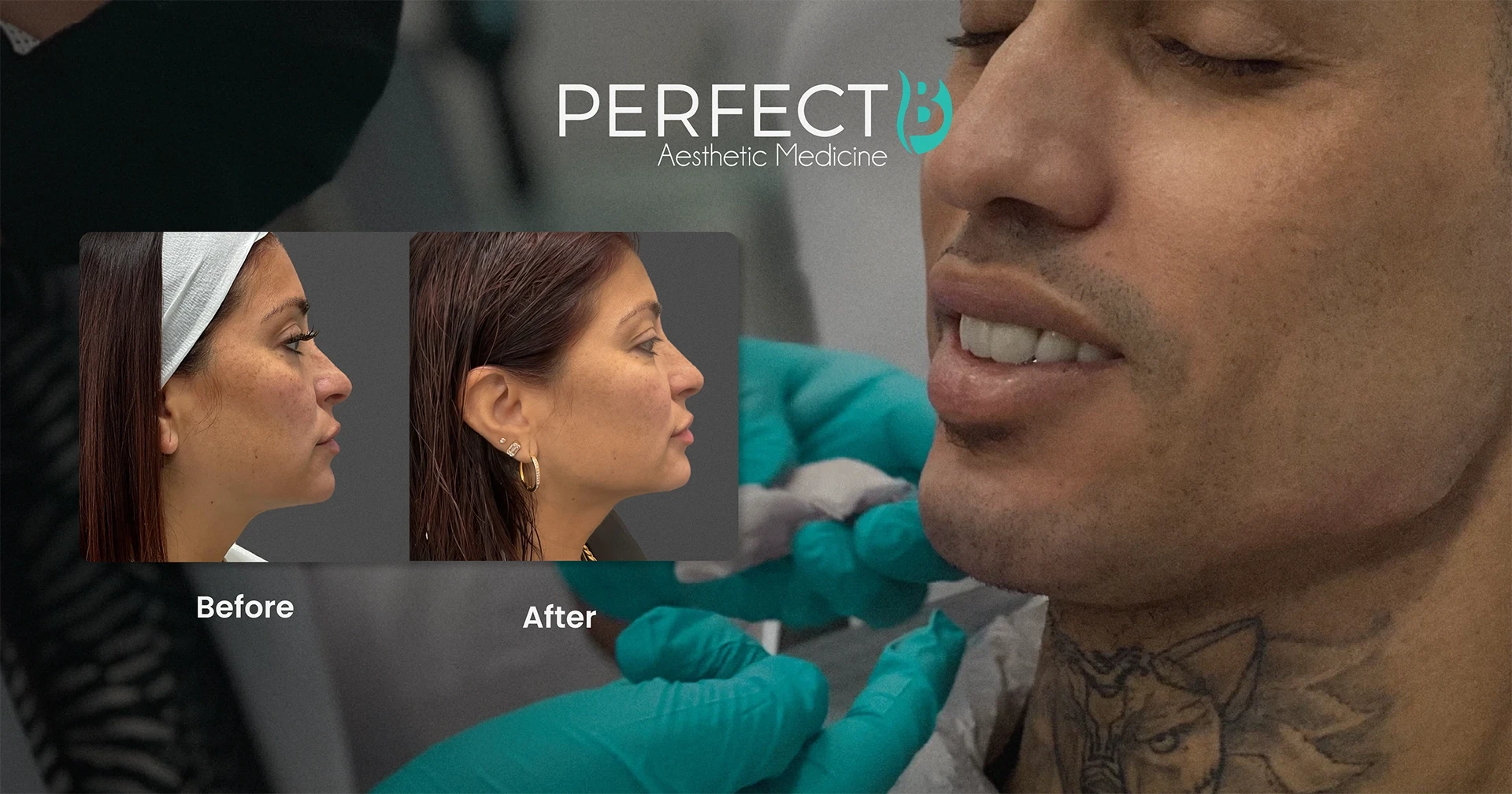 Jawline Enhancement Treatment | Perfect B