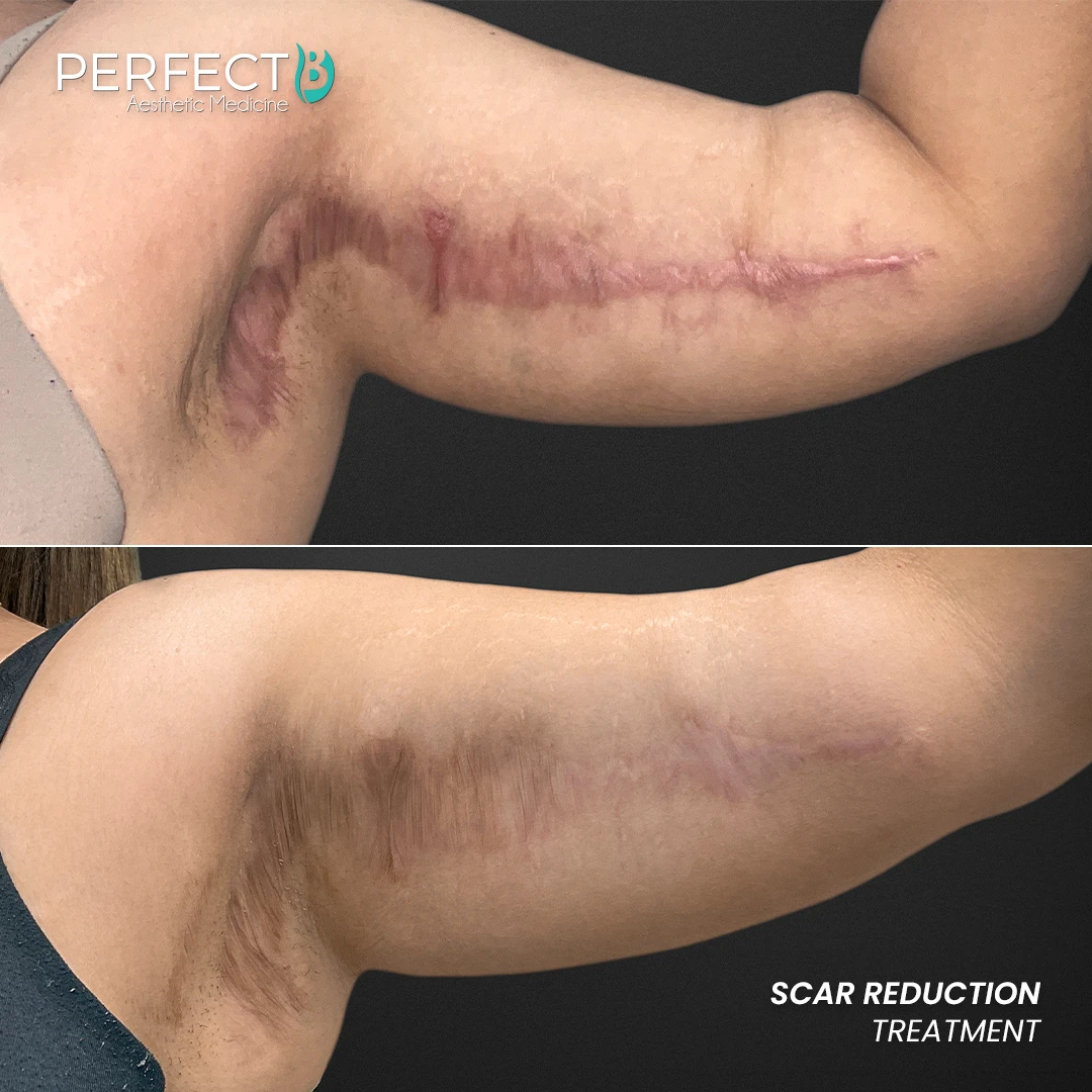 Scar Reduction Treatment Plan | Perfect B