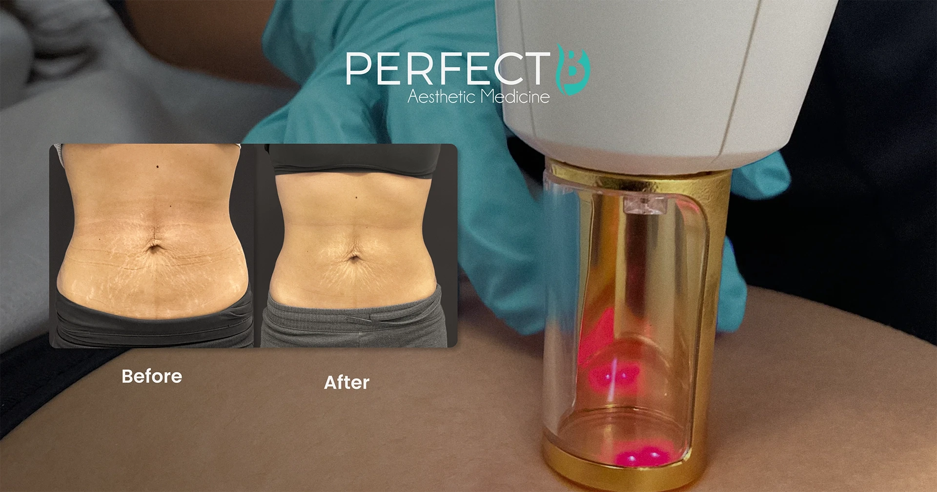Stretch Mark Reduction Treatment Plan | Perfect B