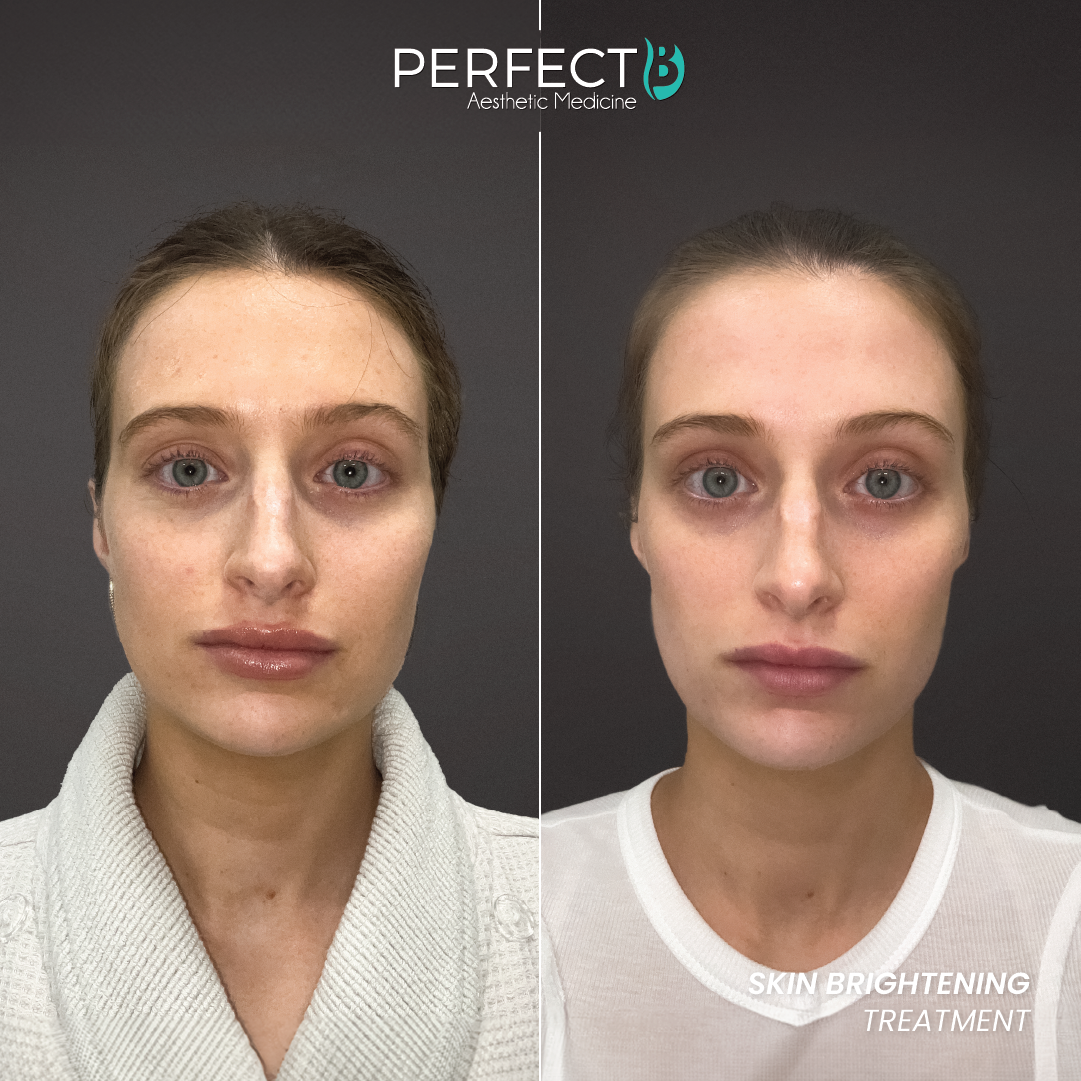 Brightening Treatment Landing | Perfect B