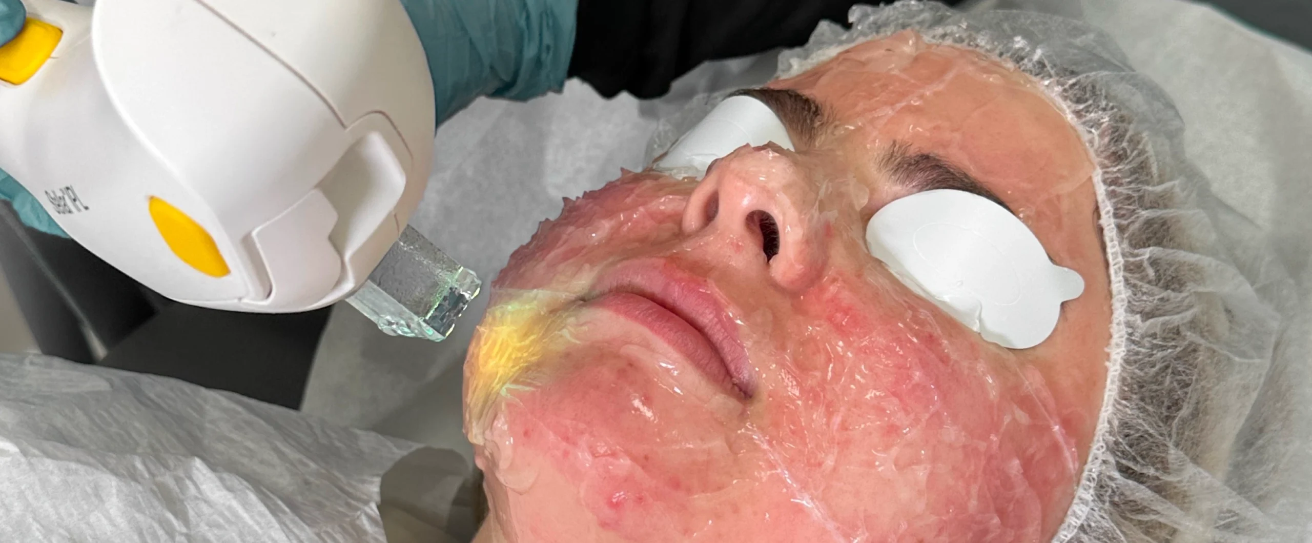 The Best Treatments for Acne Scar Removal | Perfect B